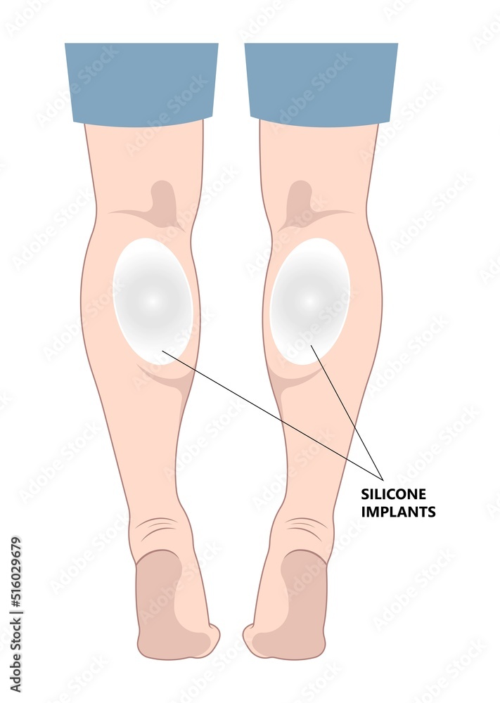 Vetor de gastrocnemius lift resection male women reshapes body calf ...