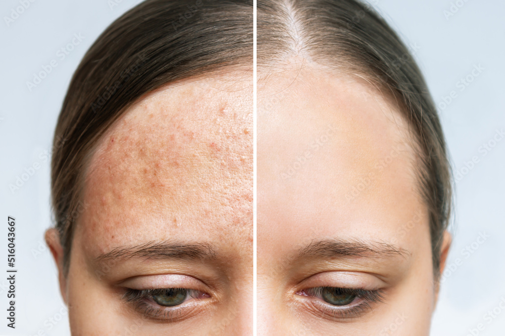 Cropped Shot Of A Young Woman s Face Before And After Acne Treatment Cropped Shot Of A Young Woman s Face Before And After Acne Treatment