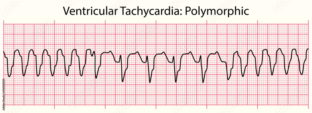 Polymorphic Ventricular Tachycardia Strip