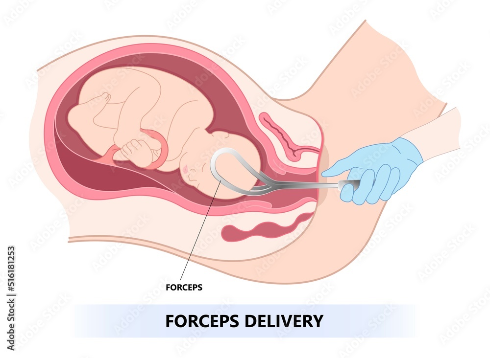 forceps assisted delivery the procedure in medical labor to pull baby from uterus fetal Vacuum ...