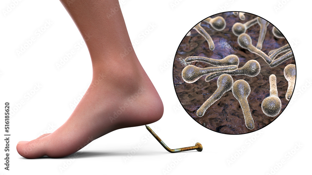 Transmission of tetanus bacteria by contaminated wounds, 3D conceptual ...