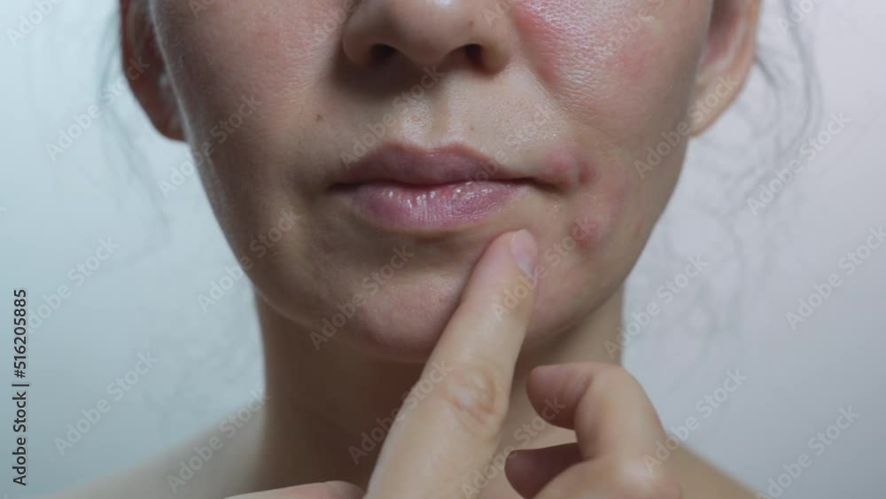 Acne on the chin: demodicosis mite on the skin of the girl's face ...