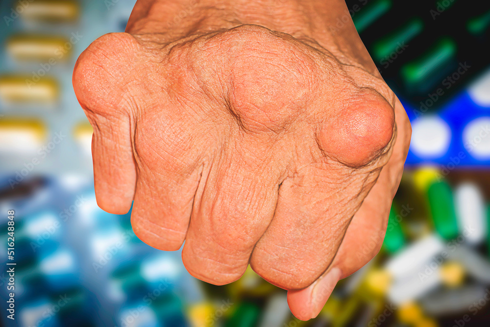 Severe gout in men suffering from joint pain, bone pain, gout ...