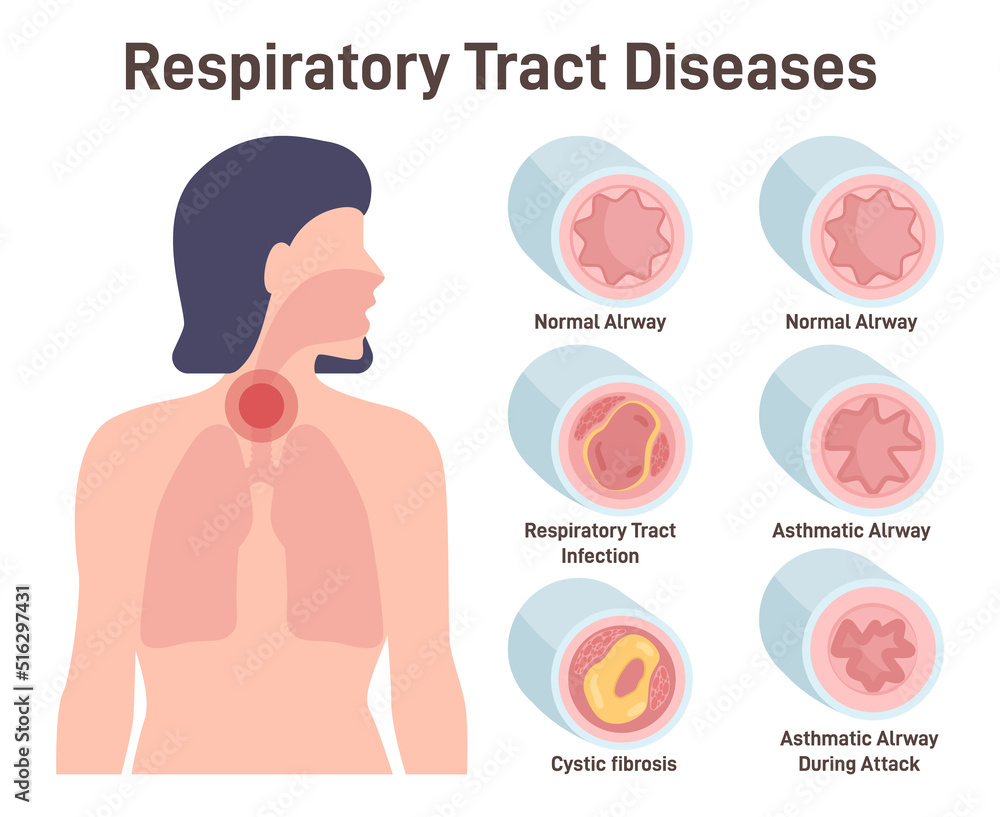 Upper respiratory tract disease. Long-term inflammatory disease Stock ...