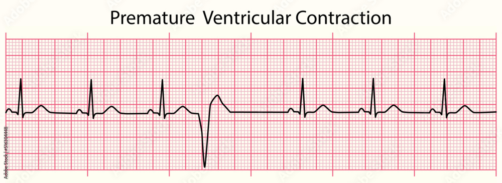 ECG line: Premature Ventricular Contraction in 6 second ECG paper line ...