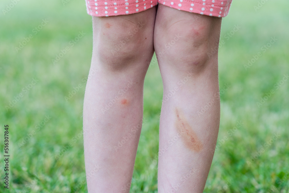 Little child with bruised leg. Bruise on child Stock Photo | Adobe Stock