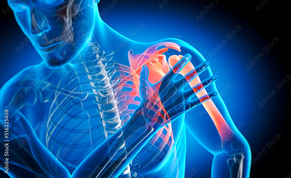 X-ray 3D Illustration of Pain in Shoulder Joint - 3D Illustration Stock ...