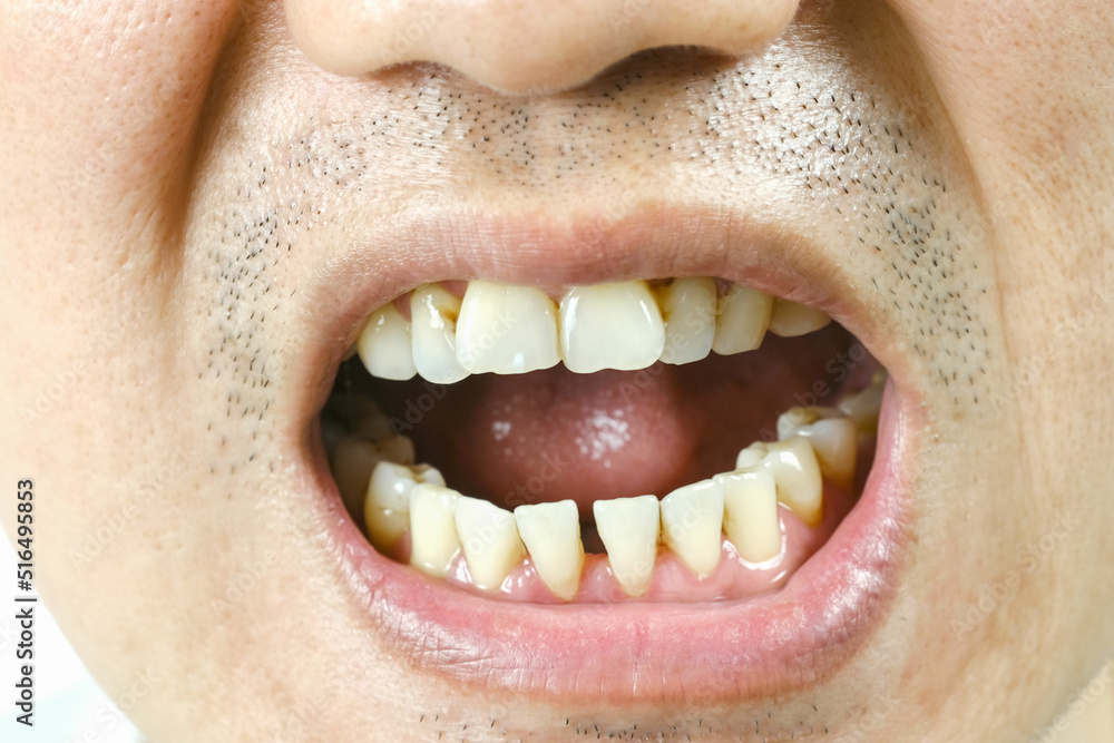 Cigarette Smokers Teeth