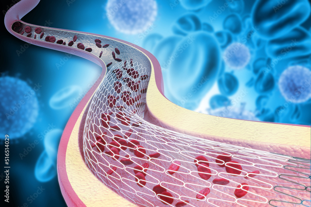 Poster Stent and catheter for implantation into blood vessels – Wall ...