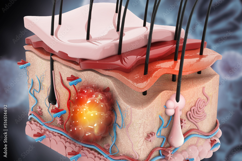 Spreading of Cancer Cell in Human Skin layer, medical diagram, 3d ...