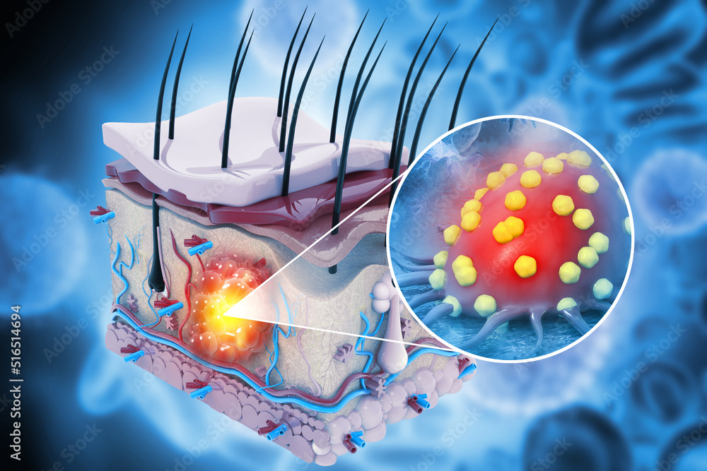 Skin cancer, medical diagram, Spreading of Cancer Cell in Human Skin ...