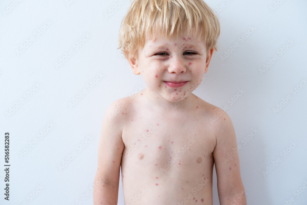 Chickenpox disease, portrait of blonde little boy with red rashes ...