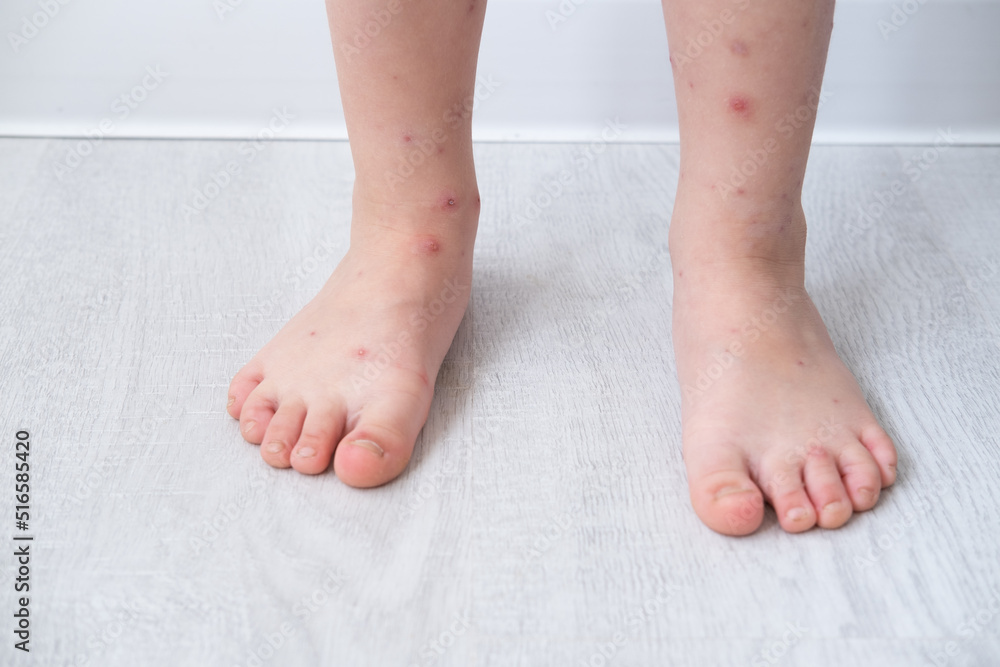 Chickenpox disease, close up little boy legs with red rashes Chicken ...