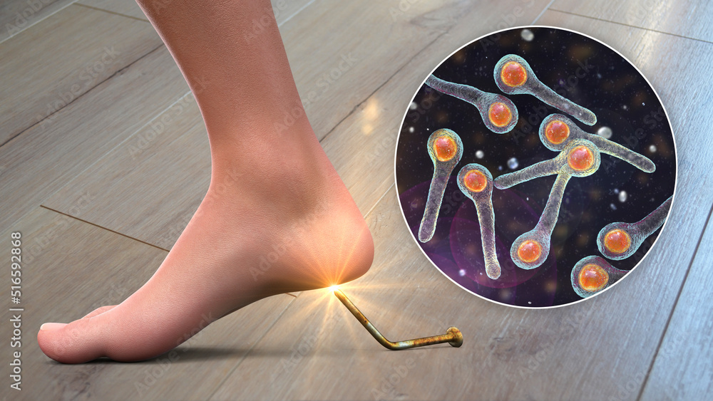 Transmission of tetanus bacteria by contaminated wounds, 3D conceptual ...