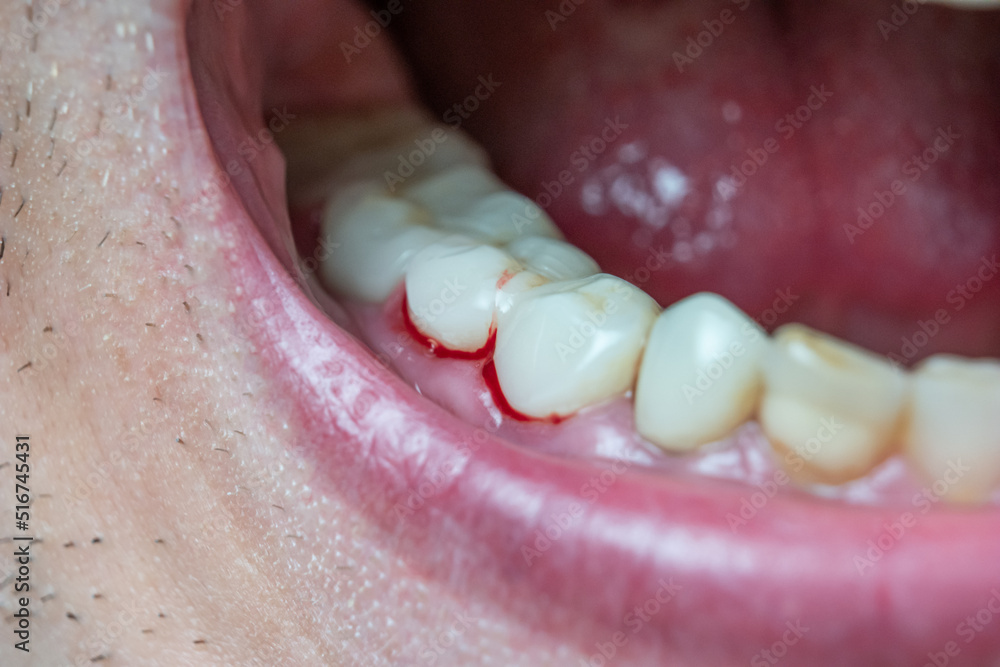 Caucasian male open mouth showing bleeding gums and a row of white ...