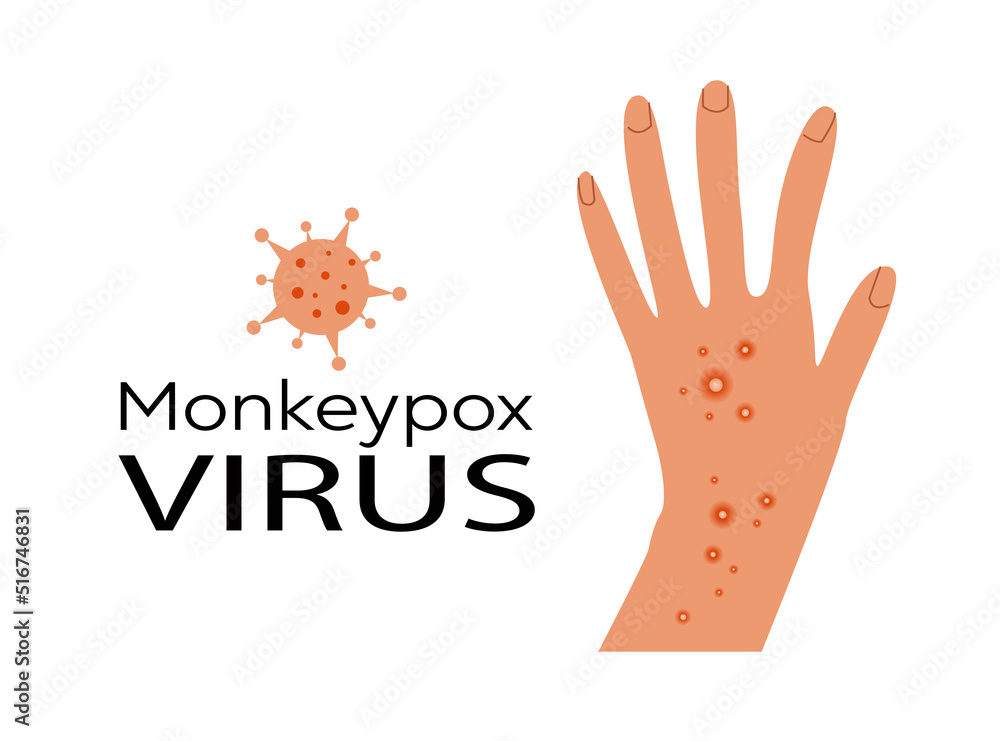 New Monkeypox virus, monkey pox with rashes on the affected arm ...