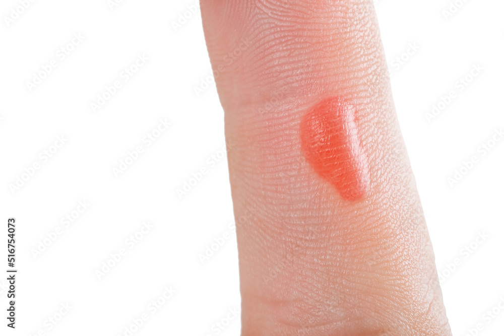 On hand finger there is red blister, the callus. Workers trauma after ...