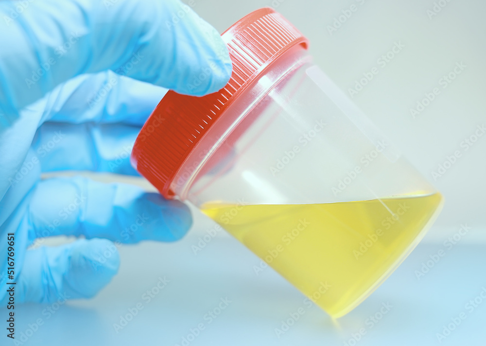 40 ml urine sample in a biomaterial container on medical background ...