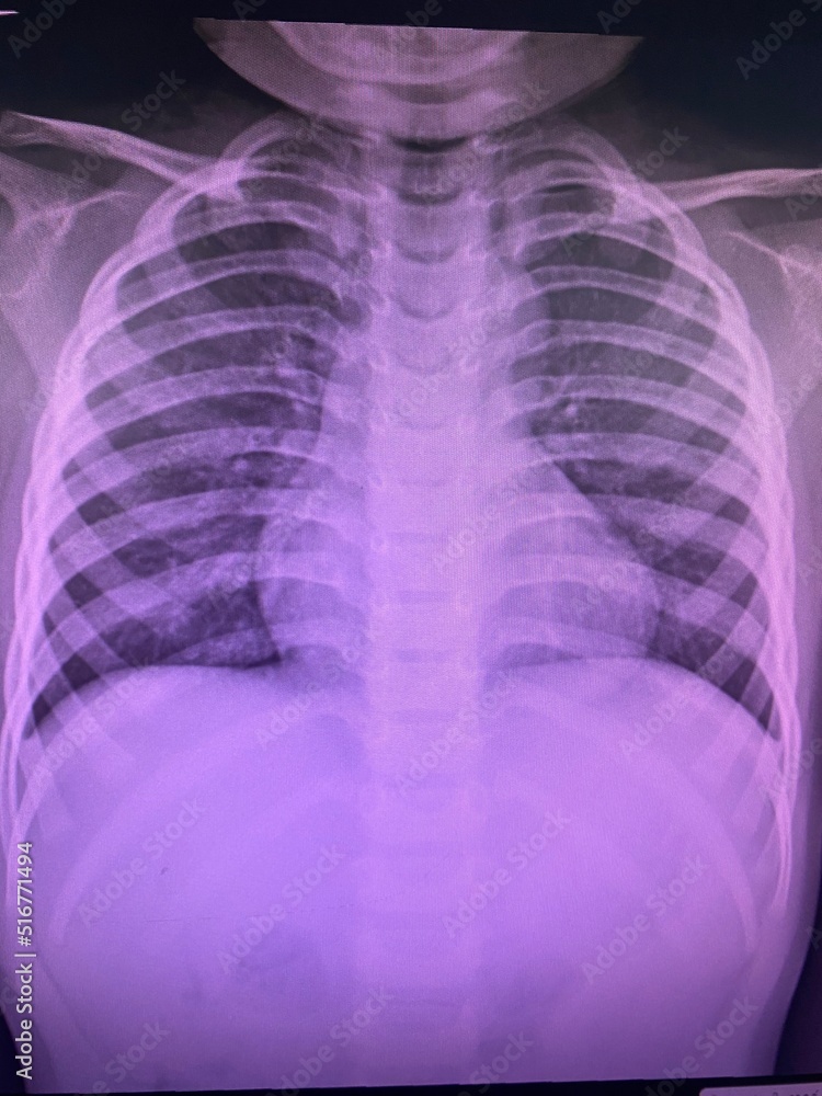 Film x-ray show Boot shape heart is the heart shape of tetralogy of ...