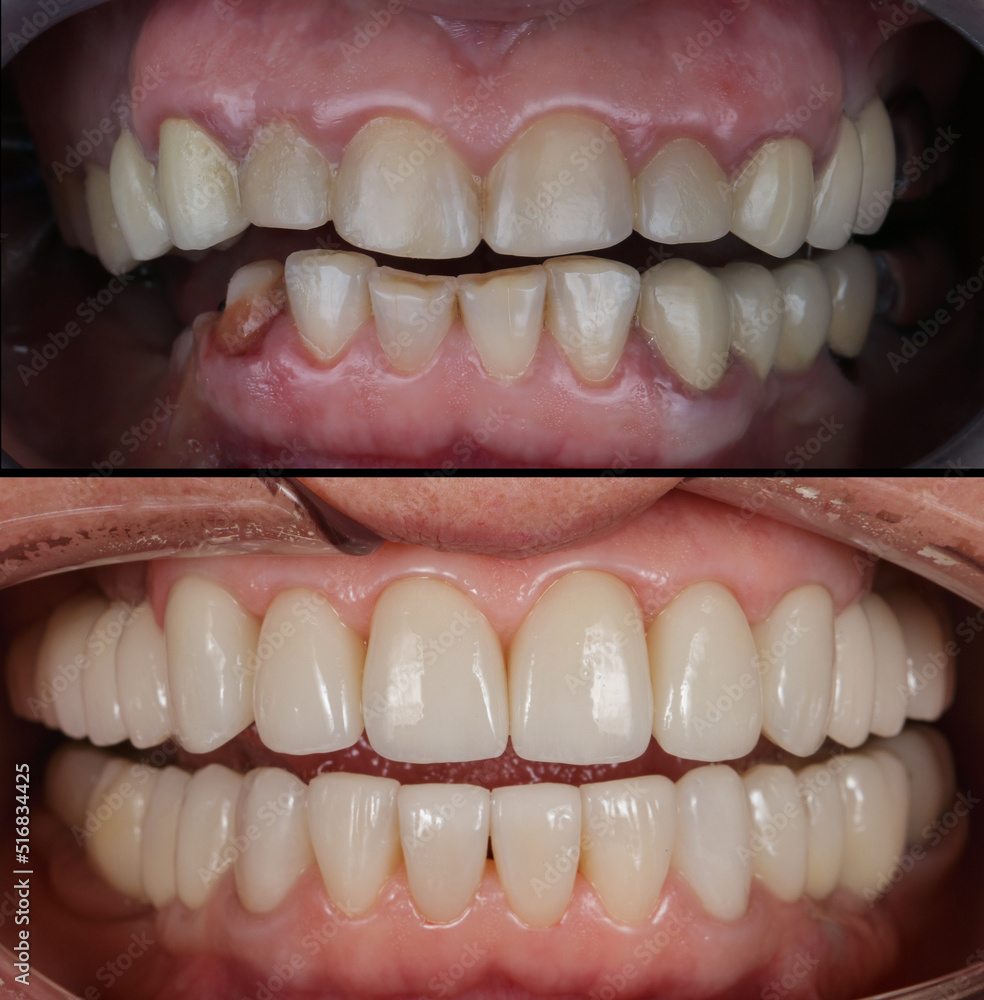 two dental photos before and after prosthetics with crowns of the upper ...