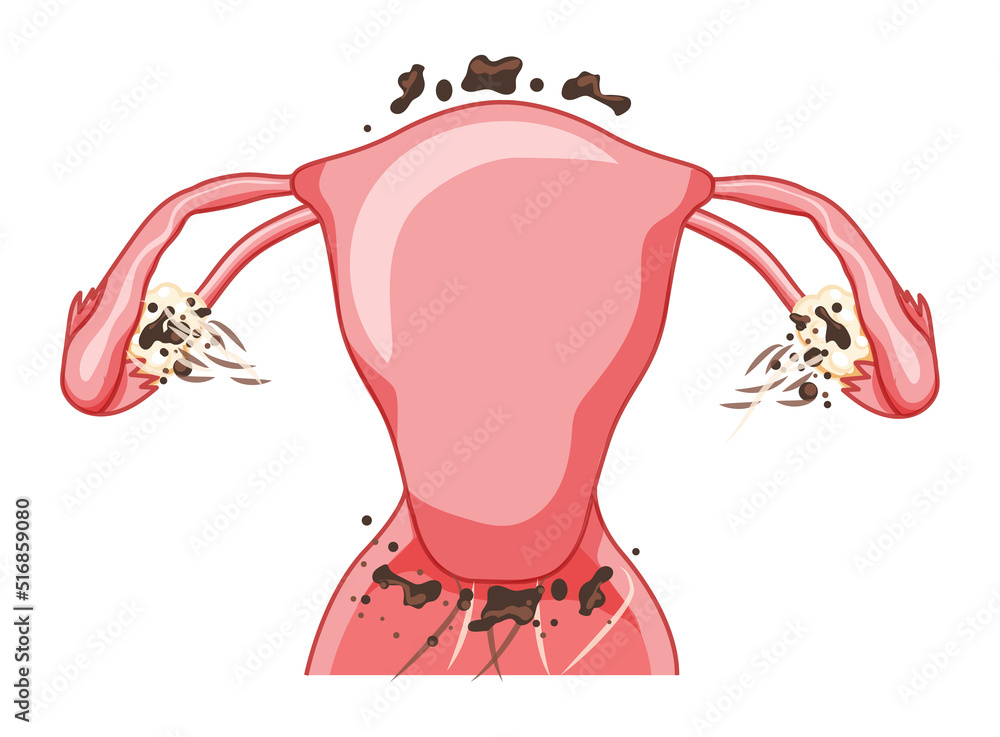 Endometriosis 3 stage Female reproductive system Front view. Human ...