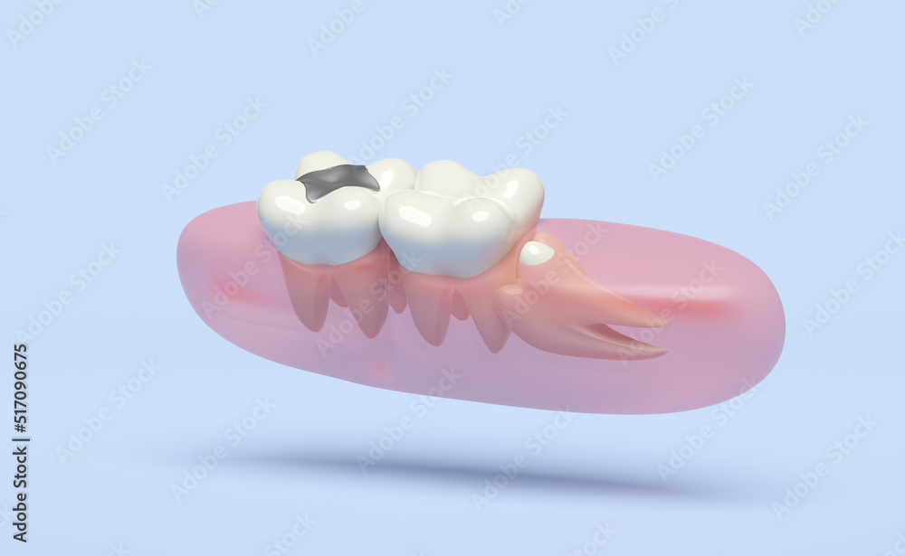 dental examination of the dentist, 3d wisdom teeth model problems icon ...