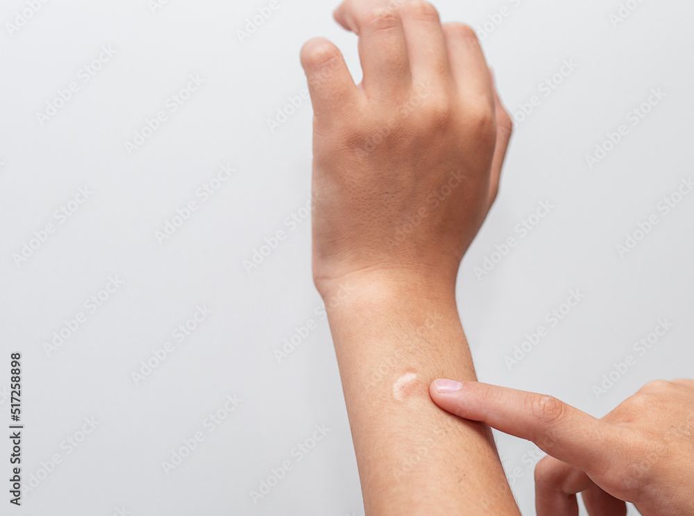 Left hand on a grey background with a scar Stock Photo | Adobe Stock