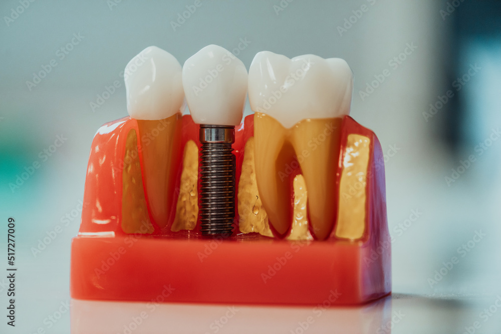 Dental prosthetics concept. Showing the installation of a dental ...