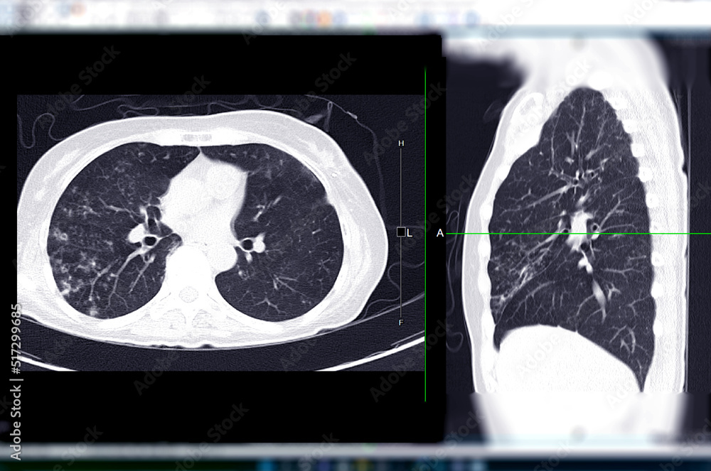 CT Chest or CT Scan of Lung Axial and Coronal View. Stock Photo | Adobe Stock