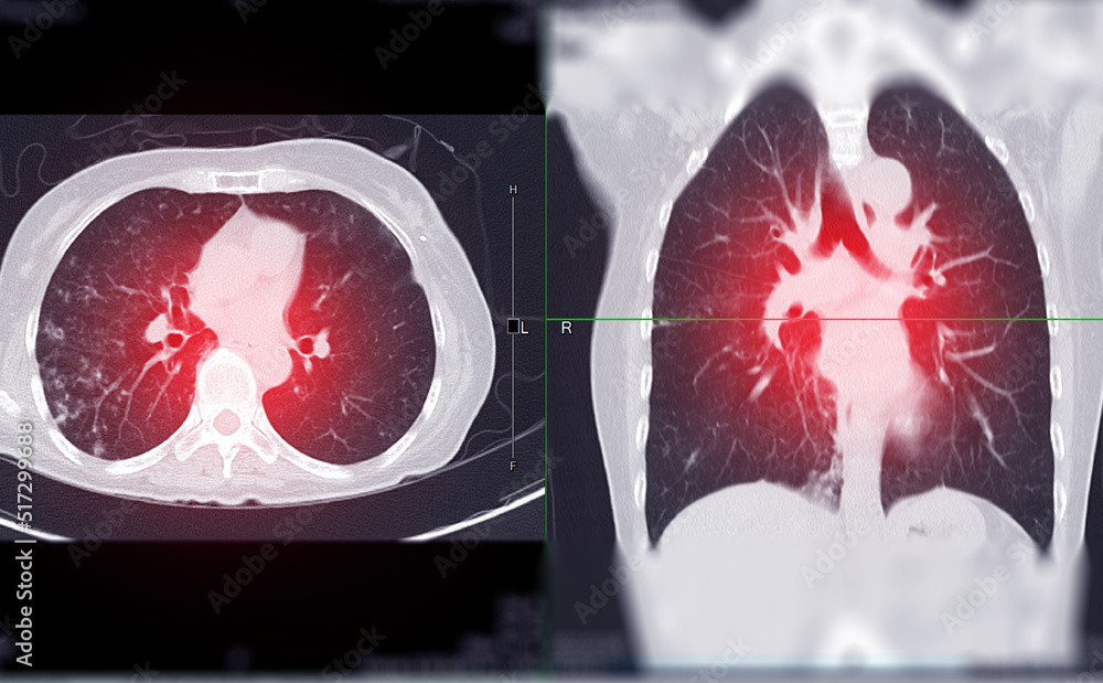 Ct Chest Or Ct Scan Of Lung Axial And Sagittal View Foto De Stock