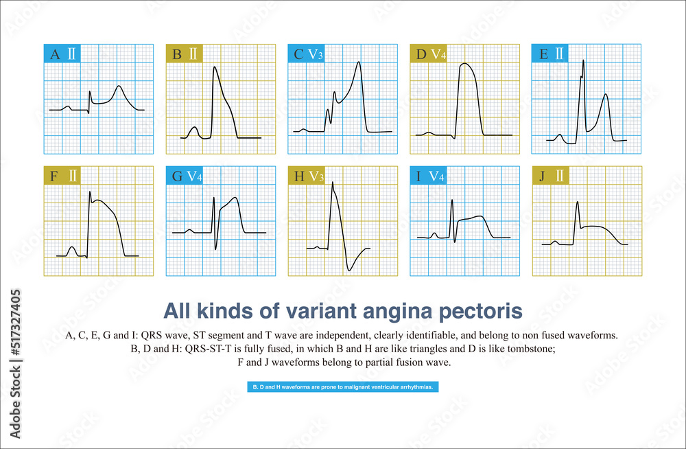During the onset of variant angina pectoris, ECG is divided into non ...