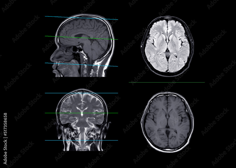 MRI brain compare axial, coronal and sagittal plane Stock Photo | Adobe ...