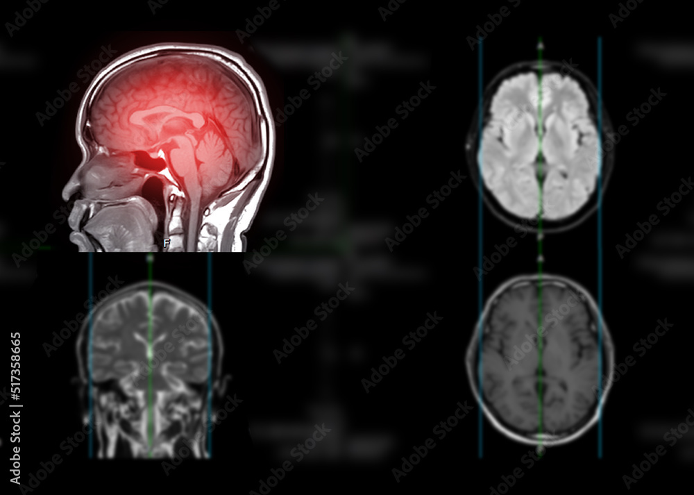 MRI brain axial T1W plane for detect stroke disease and Brain tumors and cysts. Stock Photo ...