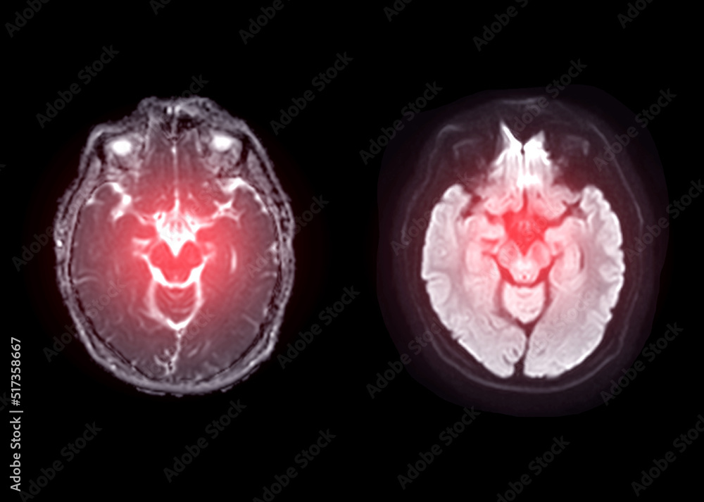 MRI brain axial diffusion image for detect stroke disease and Brain ...