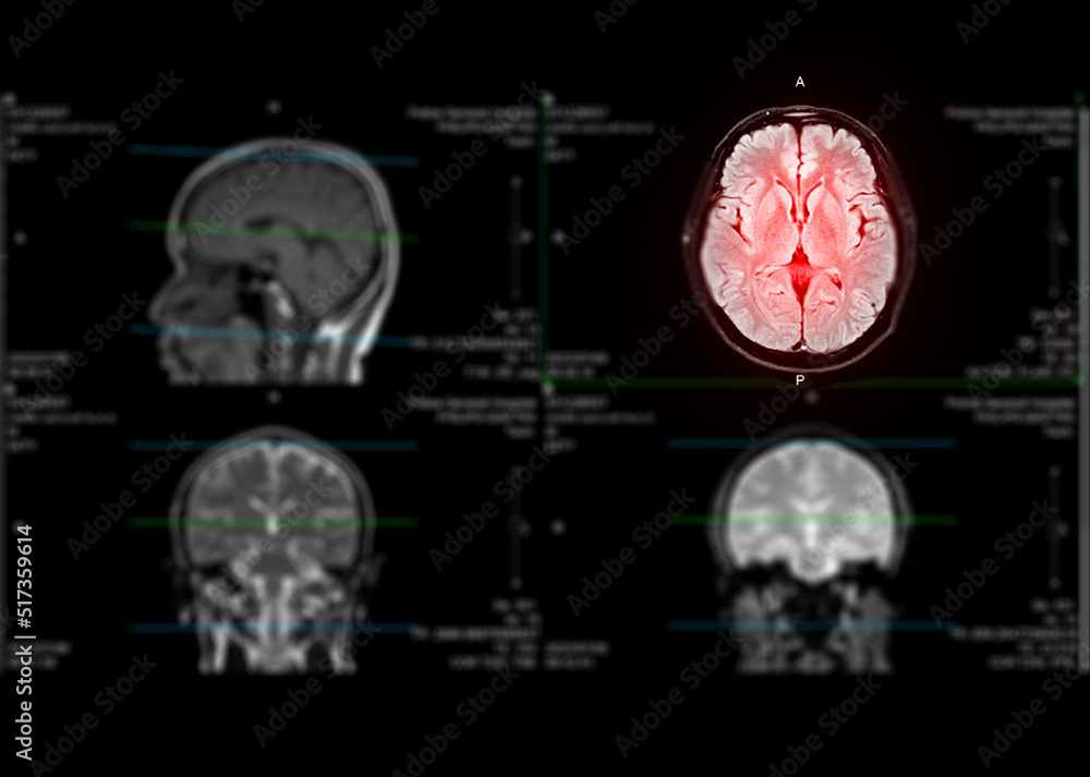 Stroke Brain Mri