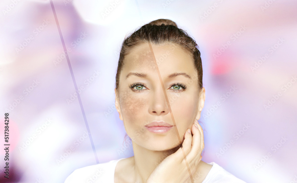 Hyperpigmentation: chloasma, melasma , age spots,Post-inflammatory ...
