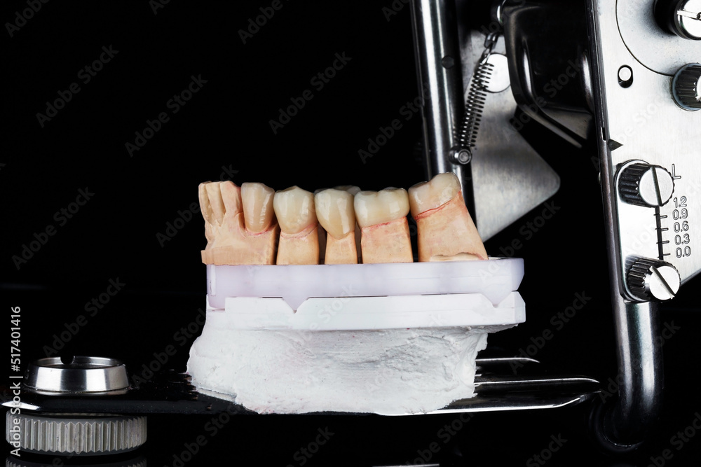 dental model with ceramic crowns in the area of chewing teeth in an ...