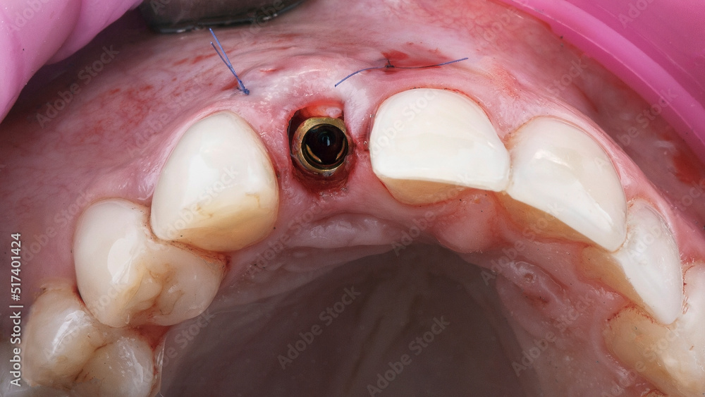 gum cavity with installed dental abutment and sutured soft tissue flap ...