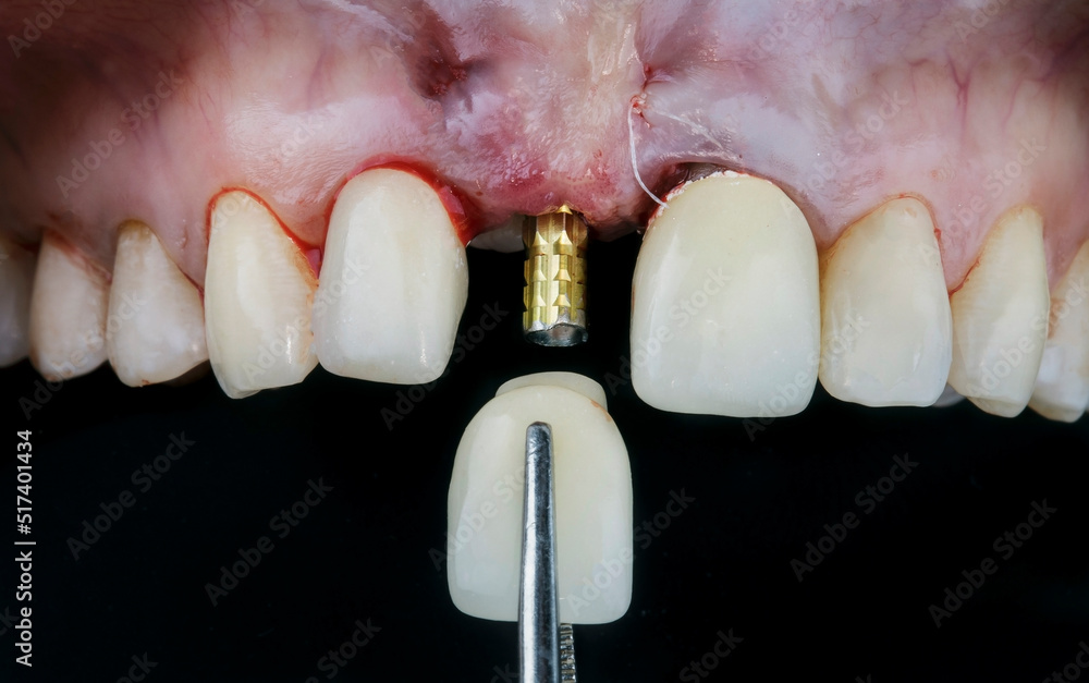 installation paste temporary dental crown of the central tooth on the ...
