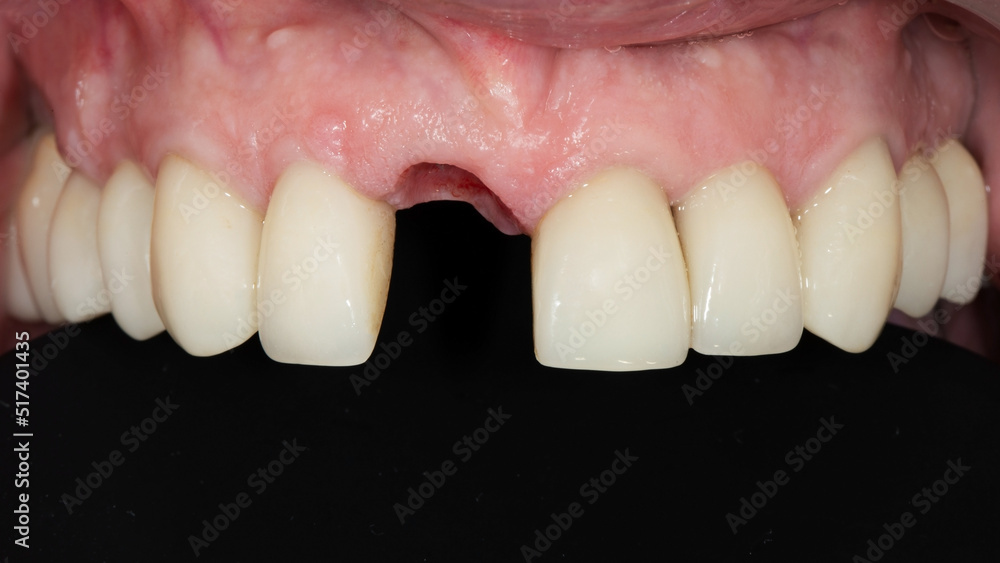 installed dental implant of the central tooth without a crown on a ...