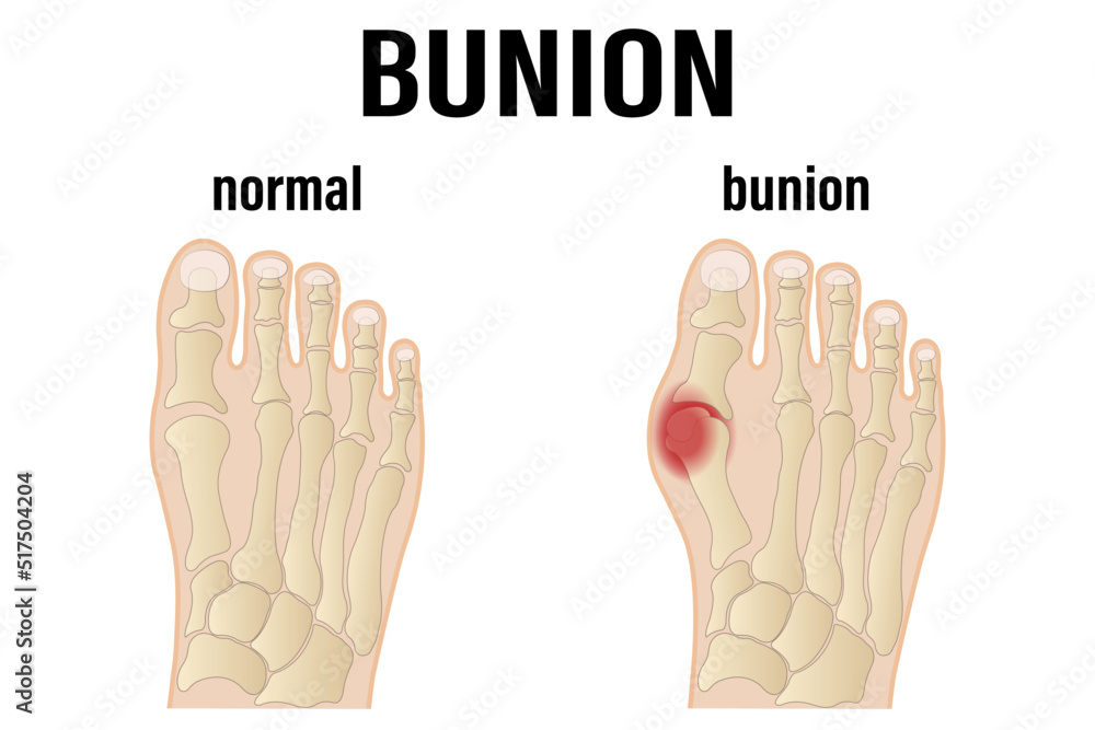 Vektorová grafika „osteoarthritis, rheumatoid arthritis and post ...