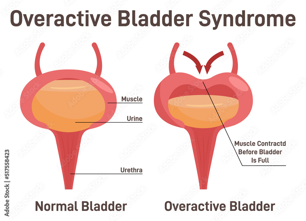 Overactive bladder syndrom. Normal bladder and bladder with urinary ...