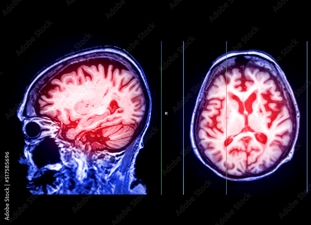 Plakát MRI brain sagittal and Axial T2 flair technique – Obraz na Zeď ...