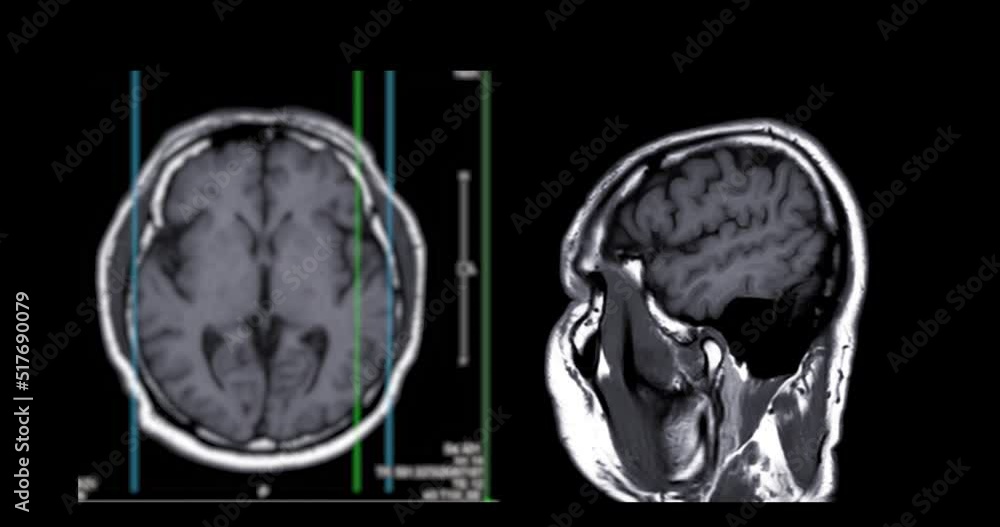 MRI of the brain for diagnosis stroke diseases. Stock Video | Adobe Stock