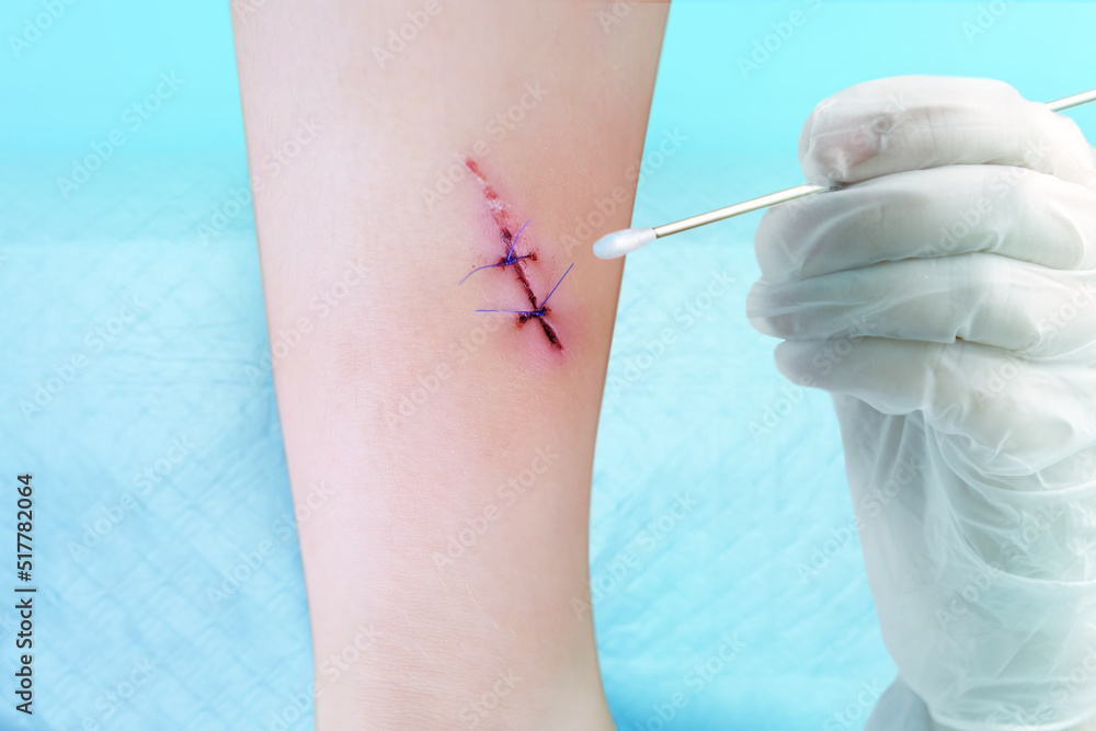fresh sutured wound on child's leg, wound care in hospital, non ...