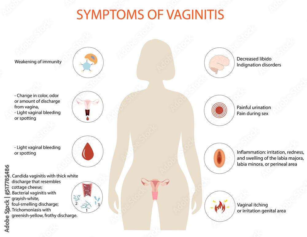Symptoms Of Vaginitis Vector Medical Illustration Stock Vector Adobe