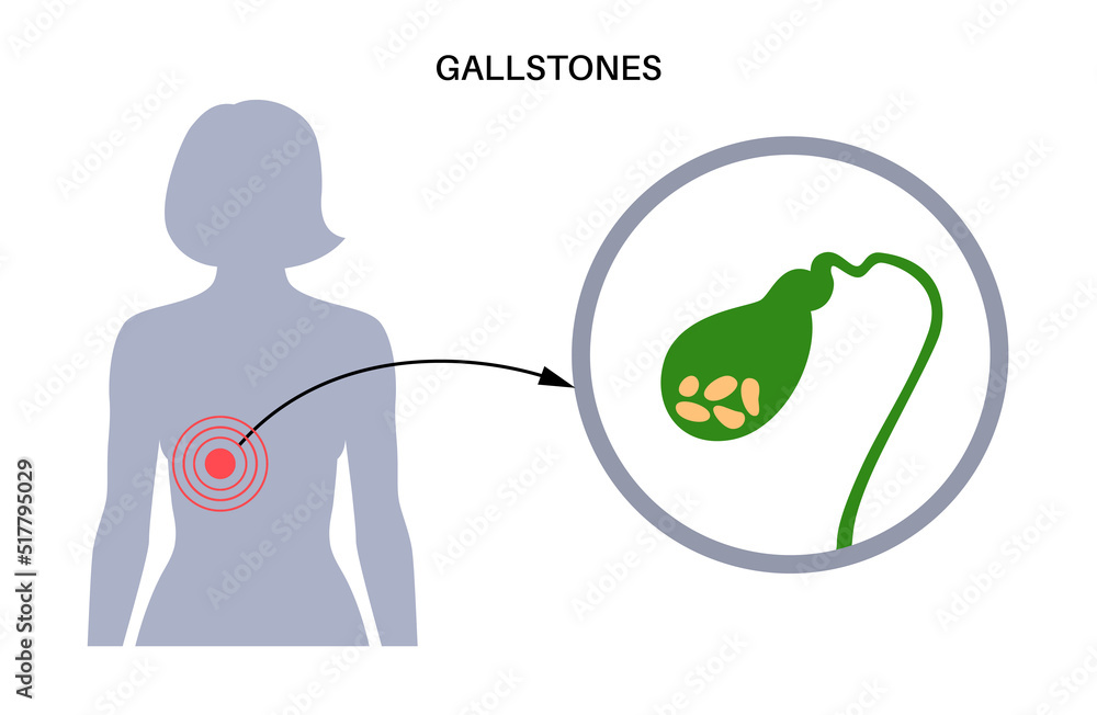 gallbladder stones anatomy Stock Vector | Adobe Stock
