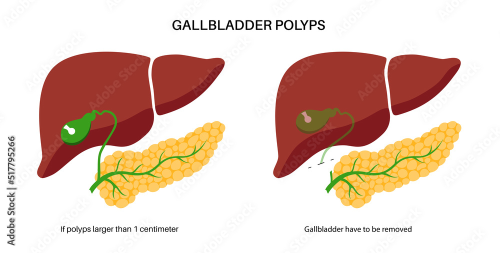 gallbladder anatomy poster Stock Vector | Adobe Stock