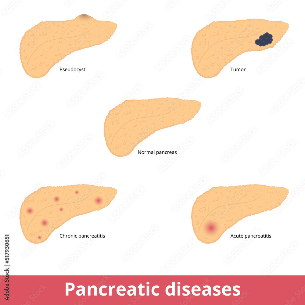 Pancreatic diseases. Visualization of common pancreatic diseases ...