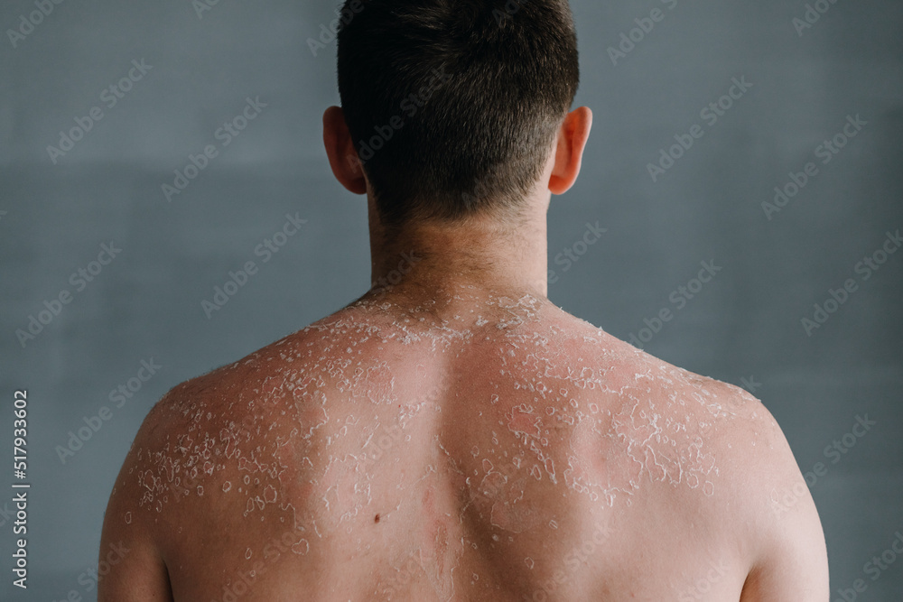 Dermatological conditions of peeling skin on man's back and shoulders ...